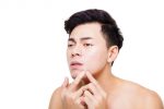 How To Get Rid of Acne Scabs (when you've popped a pimple...)