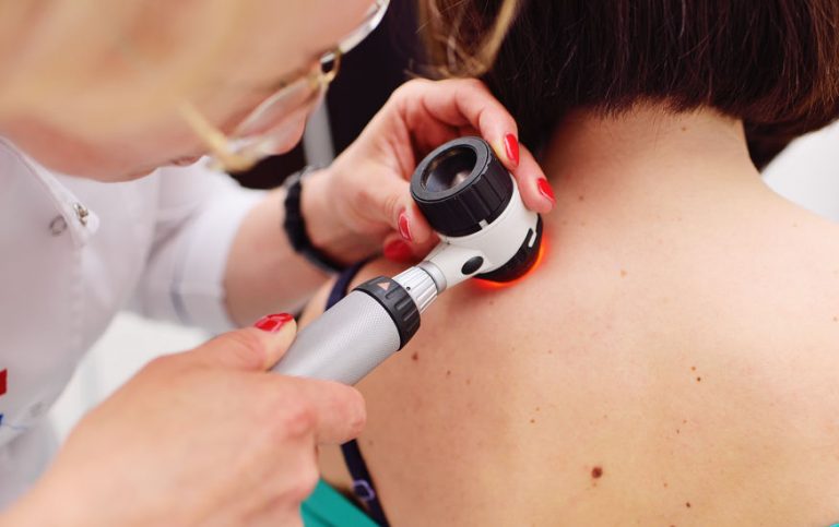 Cherry Angioma: What Do Red Moles Mean and Are They Dangerous?