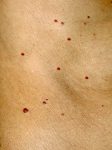Cherry Angioma: What Do Red Moles Mean and Are They Dangerous?