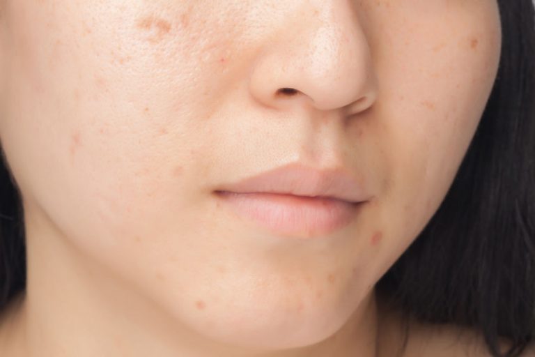 How to Fade Hyperpigmentation (and what causes it?) | Beverly Hills MD