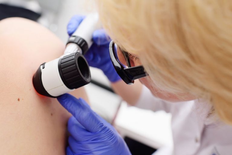 Finding Moles In Your Scalp and Hair – Causes and Treatments