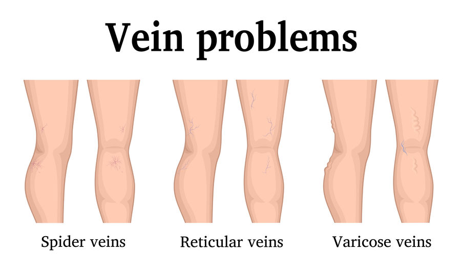 What Are Spider Veins? Learn More - Beverly Hills MD