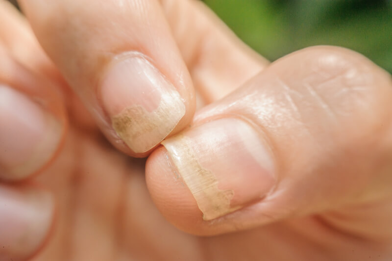 How To Get Rid Of Yellow Nails At Home: Remove Or Cover Yellow Stains ...