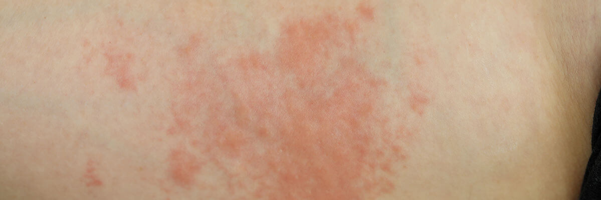 Stress And Skin: Can Stress Cause Itching And Other Skin Problems ...