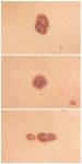 Mole Vs Freckle: How To Spot The Difference - Beverly Hills MD