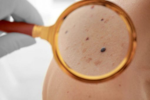 Mole Vs Freckle: How To Spot The Difference - Beverly Hills MD