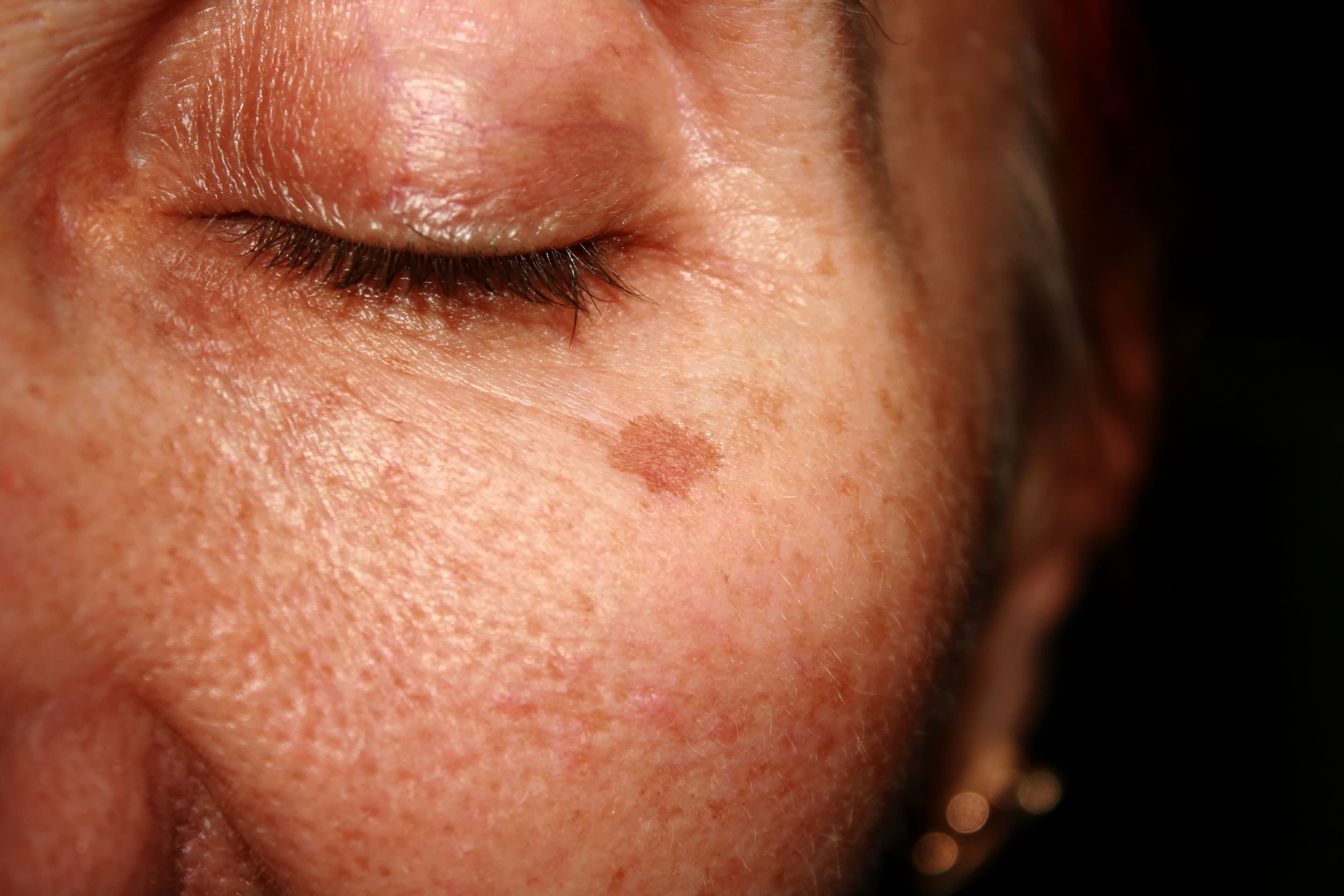 3 Easy DIY Dark Spot Remedies (And one you should avoid)
