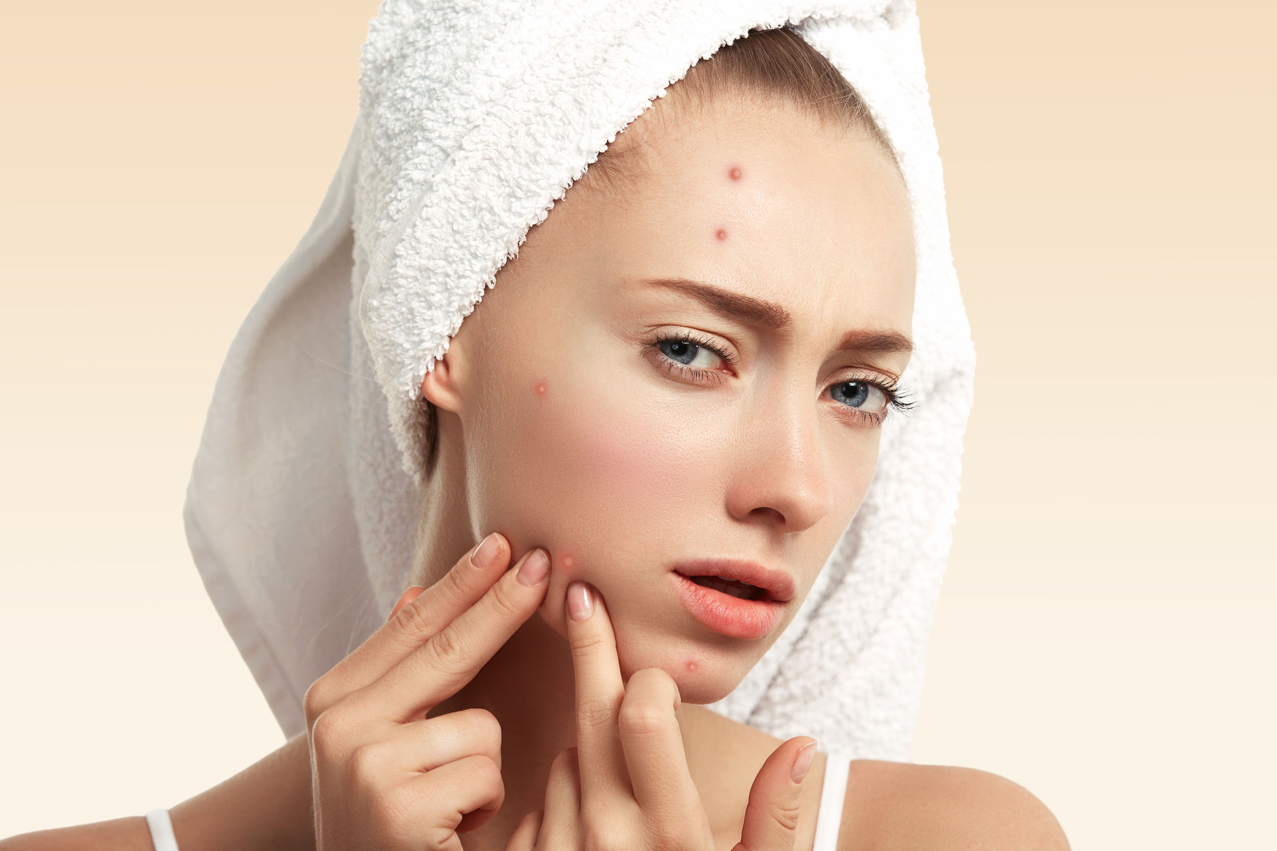 How To Get Rid of Acne Scabs (when you've popped a pimple...)