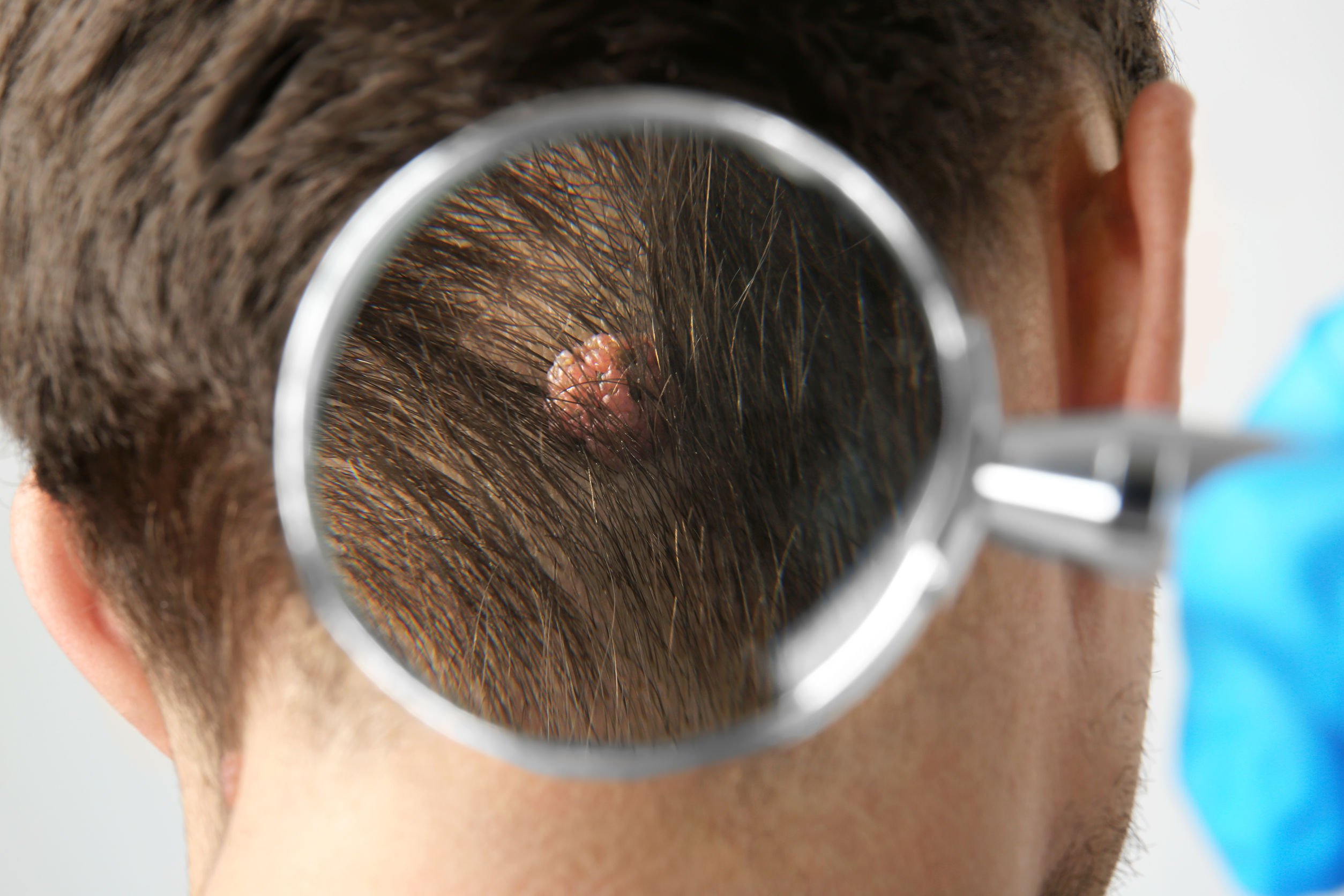 Moles on Scalp – Causes and Treatments | Beverly Hills MD